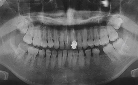Radiograph On Post Obturation Download Scientific Diagram