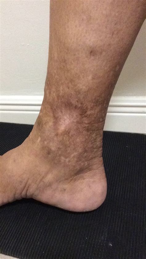 Symptoms Of Lipodermatosclerosis Miami Vein Center