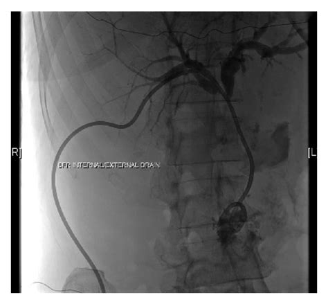Case 1—percutaneous Trans Hepatic Cholangiography Ptc With 8 French Download Scientific