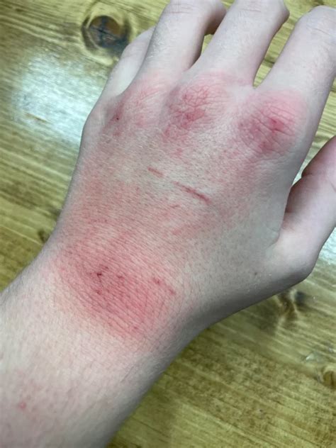 Scratched By A Stray Cat Heres Your Quick Safety Guide