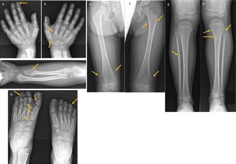 Radiographs Of Proband A B Multiple Bilateral Metacarpal And Download Scientific Diagram