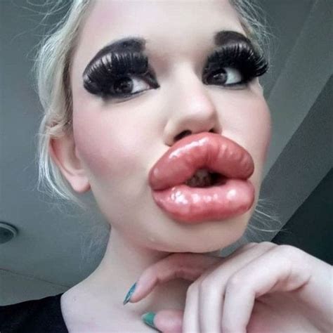 Funny Lip Filler Lip Filler Meme Lips Woman Fake Lips