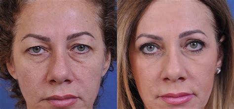 Blepharoplasty Eyelid Surgery Archives Stepanyan Surgical Arts Center