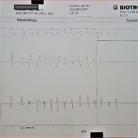 Electrocardiographic Intracardiac Aspect Of Polymorphic Ventricular