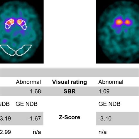 Blandaltman Plot For Putaminal Sbr Between The Czt And Nai Camera