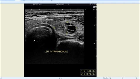 좌측 갑상선 14 7 Mm 크기의 낭성 변성을 동반한 등에코 결절 K Tirads 3 결절 62세 여성 Youtube