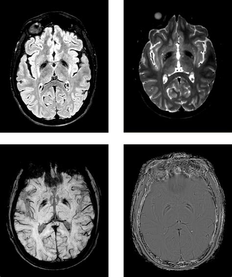 Compound Heterozygous Mutation Of The Beta Galactosidase 1 Gene Presenting With Familial