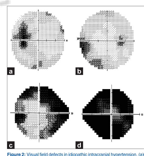 Neurological Visual Field Defect