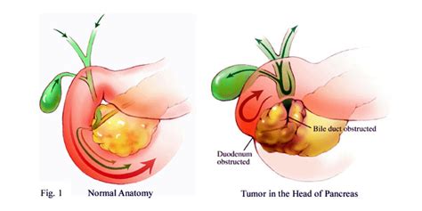 Palliative Double Bypass Gallbladder And Bile Duct Cancer Johns