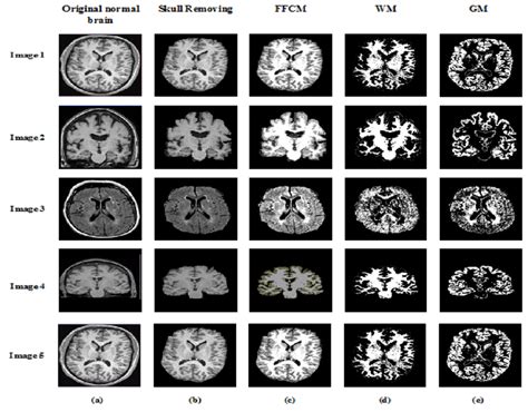 Segmentation Result Of Wm And Gm In The Normal Brains A Original