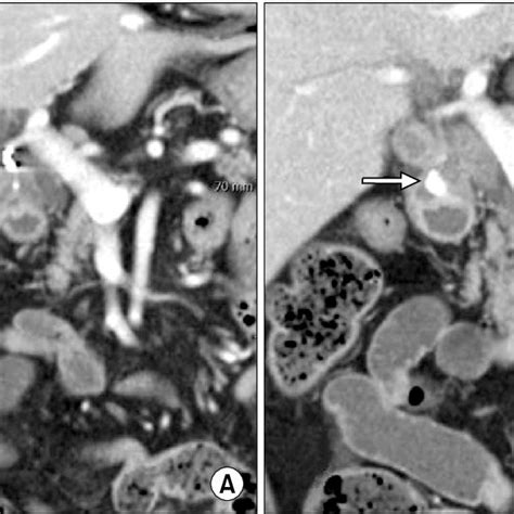 Endoscopic Findings Endoscopy Shows An Active Duodenal Ulcer With An