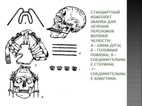 Лечение переломов верхней челюсти презентация онлайн