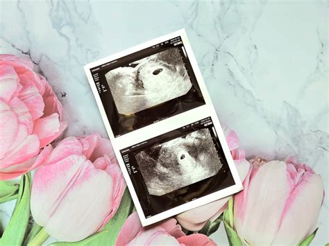 노산임신 시험관 11차만에 임신 네이버 블로그