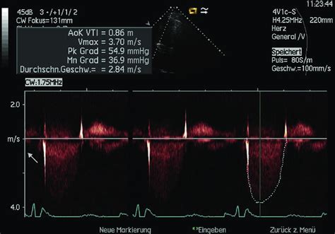 Continuous Wave Doppler Signal Across Aortic Valve Demonstrating A