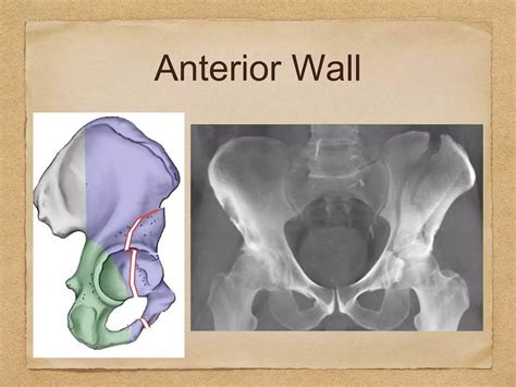 Acetabular Fracture Radiology Xrays Ct Scan And 3d Printing Pptx