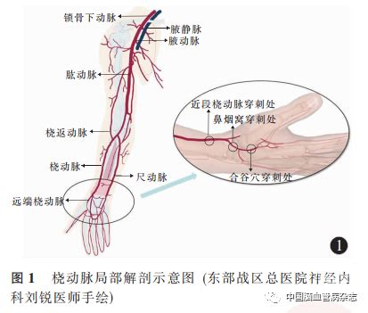 经桡动脉或远端桡动脉入路行脑血管介入操作中国专家共识 脑医汇 神外资讯 神介资讯