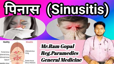 Sinusitis पिनास Causes Symptoms How To Treat Sinusitis In Nepali Youtube
