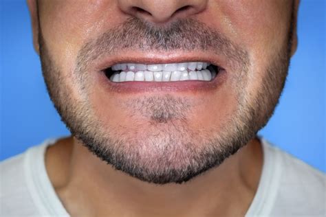 Decalcification After Braces Causes Fixes And Prevention