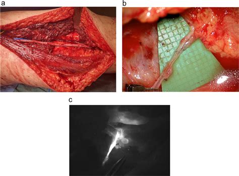 A Large Wound Cavity After Sarcoma Resection Of The Proximal Medial