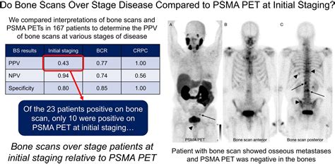 Do Bone Scans Overstage Disease Compared With Psma Pet At Initial