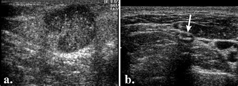 Intranodal Calcification A Sparse Microcalcification In A Thyroid