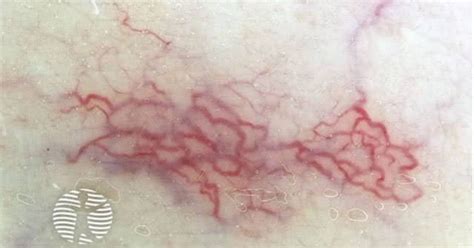 Dermoscopy Image