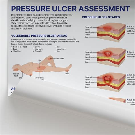 Pressure Ulcer Grading Poster Surgical Nursing Medical