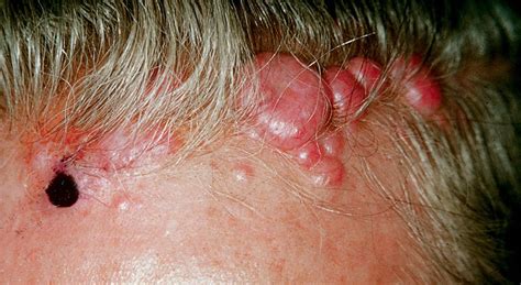 Enlarging Scalp Nodules On 56 Year Old Patient
