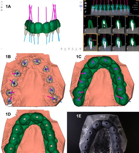 Ab Endodontic Access Cavities Planned With The Computer Aided Static Download Scientific