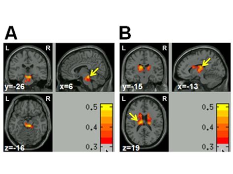 Resting State Functional Connectivity Fc Analysis Results A