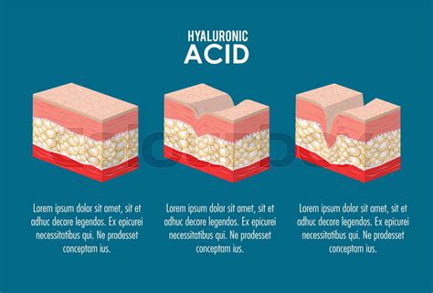 Hyaluronic Acid Filler Injection Infographic Flyer Vector Il Colourbox