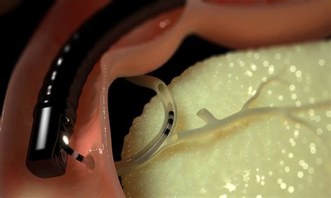 Was Ist Ercp Prof Dr Cengiz Pata Was Ist Ercp Prof Dr Cengiz Pata