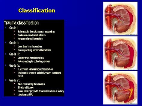 UROLOGICAL TRAUMA RENAL TRAUMA N Renal Trauma Occurs