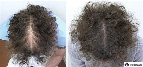 Topical Finasteride For Hair Loss Efficacy Side Effects And Results