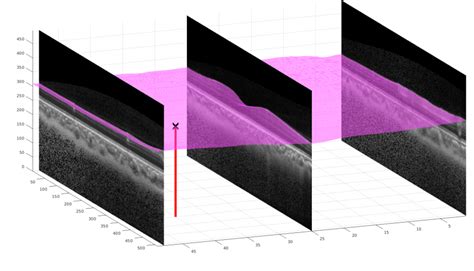 Figure 1 From Layer Boundary Evolution Method For Macular Oct Layer
