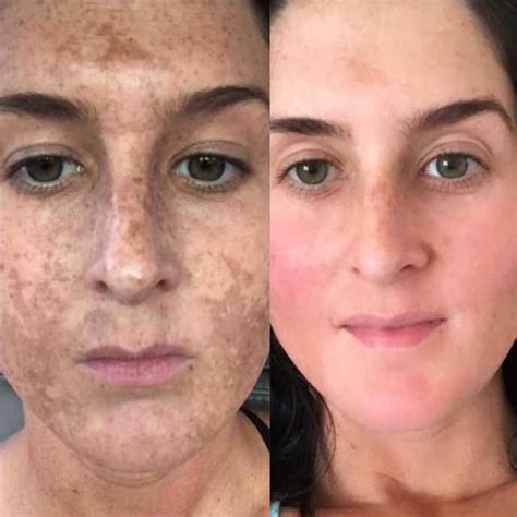 Musely Before And After F