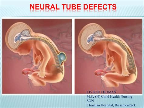Neural Tube Defects Pptx