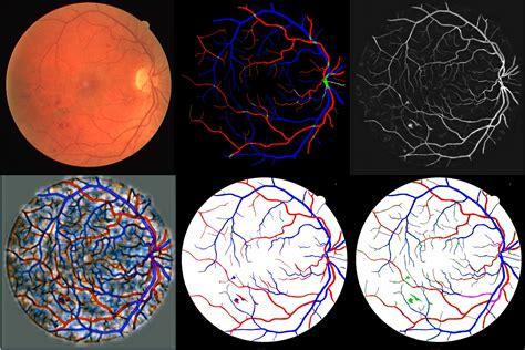Joint Segmentation And Classification Of Retinal Arteriesveins From Fundus Images Deepai