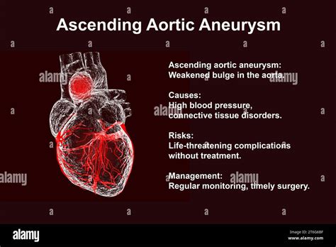 A Human Heart With An Ascending Aortic Aneurysm 3d Illustration