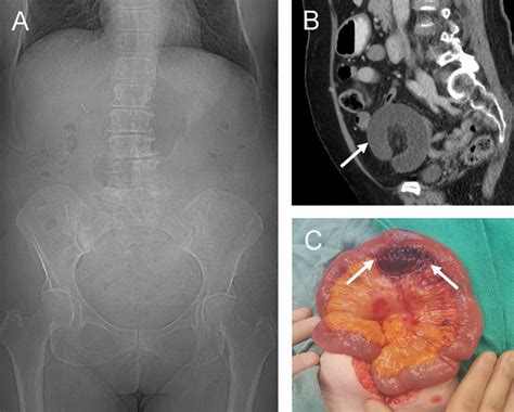 Patient With A Closed Loop Obstruction A Frontal CT Scout Image Shows Download Scientific