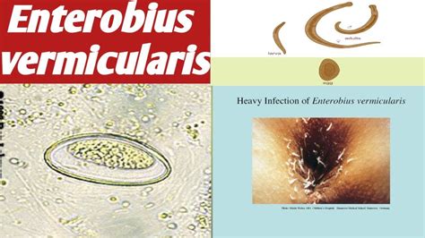 What Is Enterobius Vermicularis Pinworm Ahmaric Tutorial Youtube
