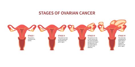 Ovarian Cancer Management Mims Singapore