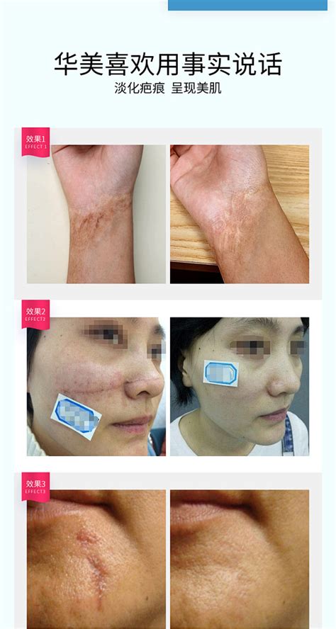 上海华美医疗美容医院 激光祛疤痕烧烫伤手术疤痕修复 非疤痕贴膏 天猫