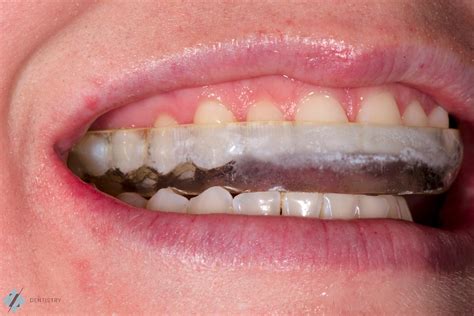 What Is The Purpose Of Mouth Guard At Skye Kinsella Blog