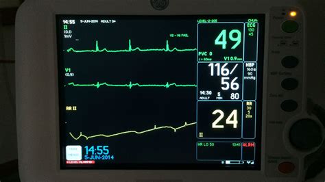 Using AI To Spot Hospitals Silent Killer NOVA Next PBS