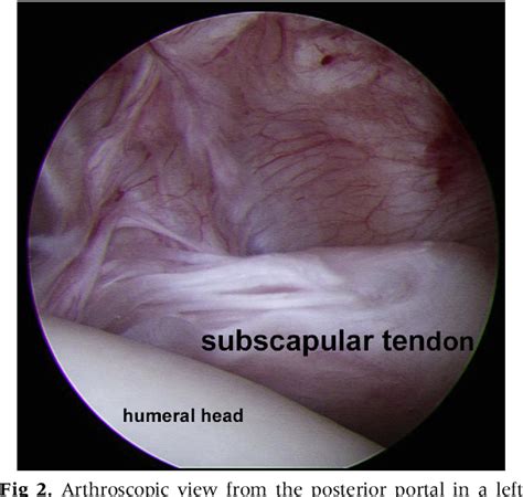 Scapular Lymph Nodes Semantic Scholar