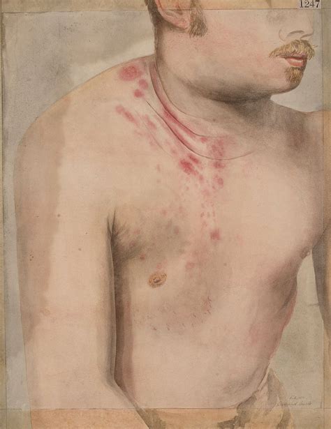 Sarcoma Images Free Photos Png Stickers Wallpapers And Backgrounds