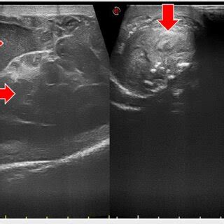 Ultrasound Scrotum Image 2 Download Scientific Diagram