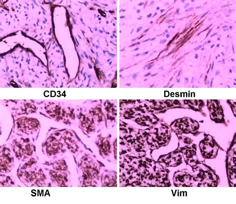 Figure 1 From Ovarian Sclerosing Stromal Tumor In A Young Woman With