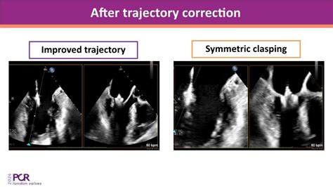 Transforming Interventional Care For Patients With Mitral Regurgitation Simulation And Case
